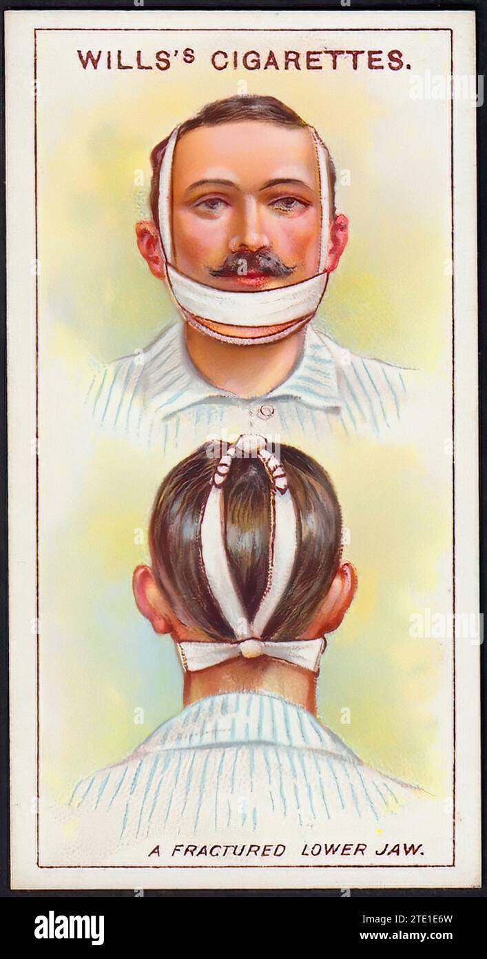 First Aid, Fractured Jaw - Vintage Cigarette Card Illustration Stock ...