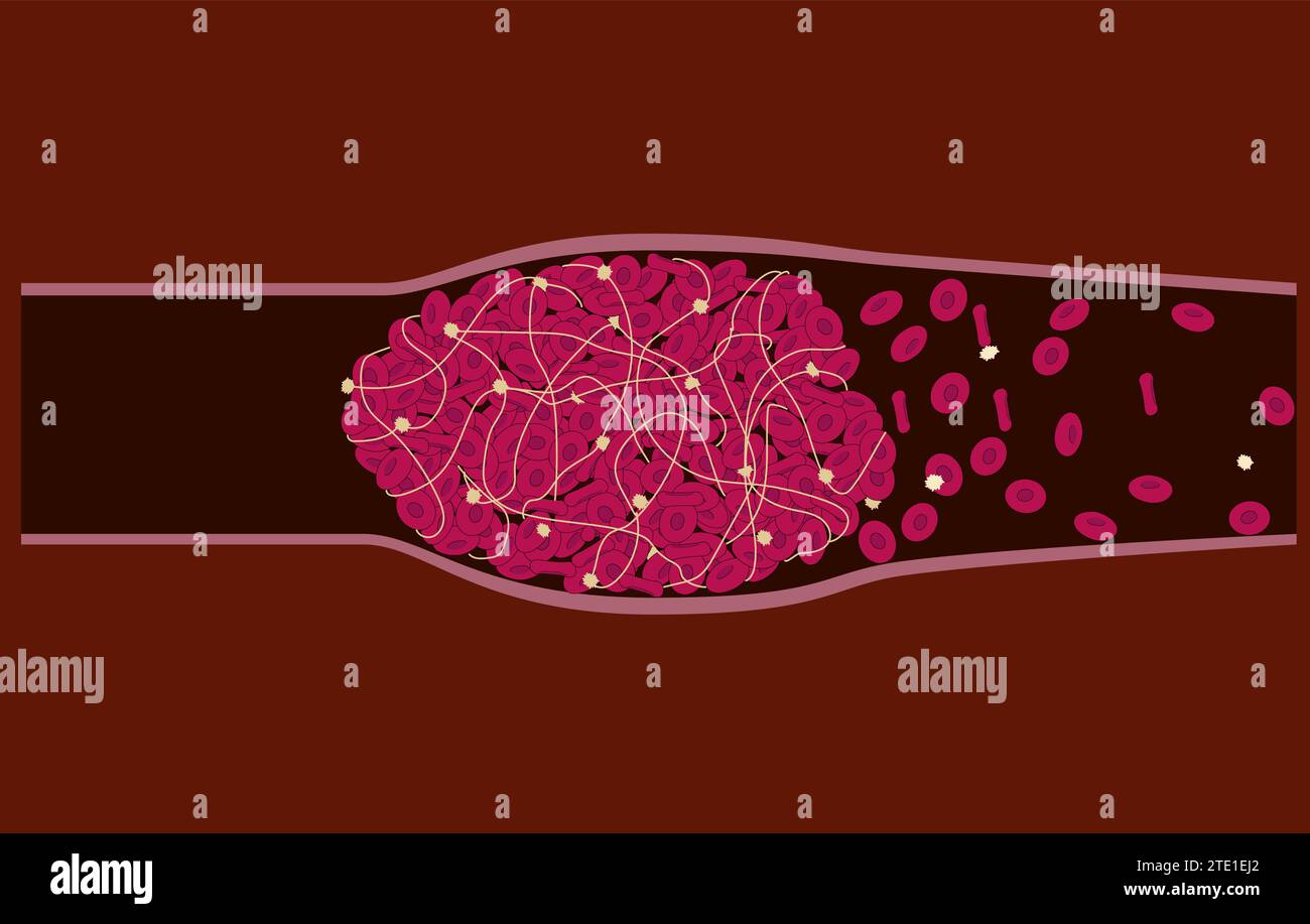A blood clot stops the flow of the blood in a vein and causes its ...