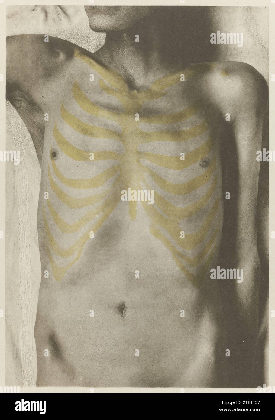 Anatomical photo of a male corpse: 'The shape of the chest in relation ...
