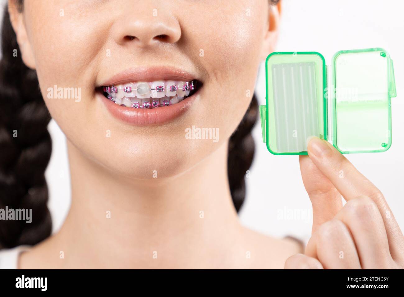 Close up of young Caucasian woman with brackets on teeth show little ...