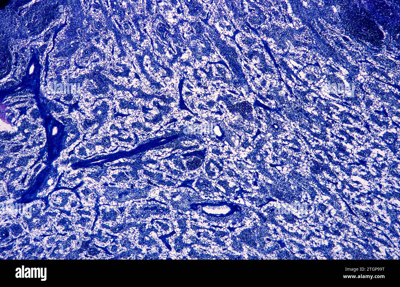 Jugular Lymph Nodes