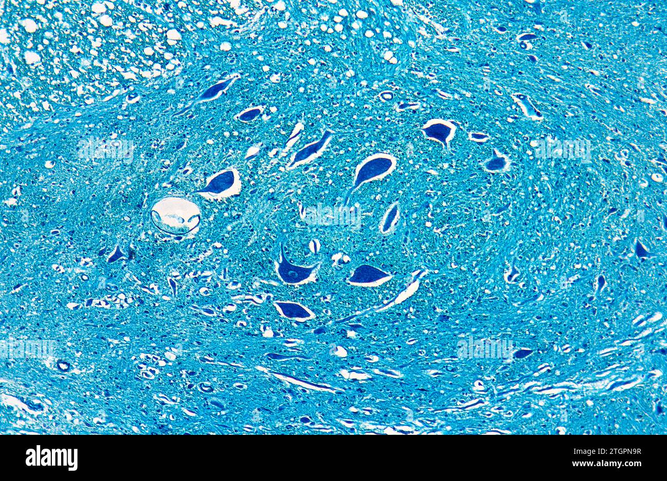 Multipolar motor neurons on spinal cord. Photomicrograph Stock Photo ...