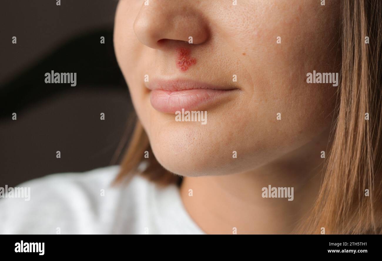 Close up woman's hand touches inflamed sores with blisters from labial ...
