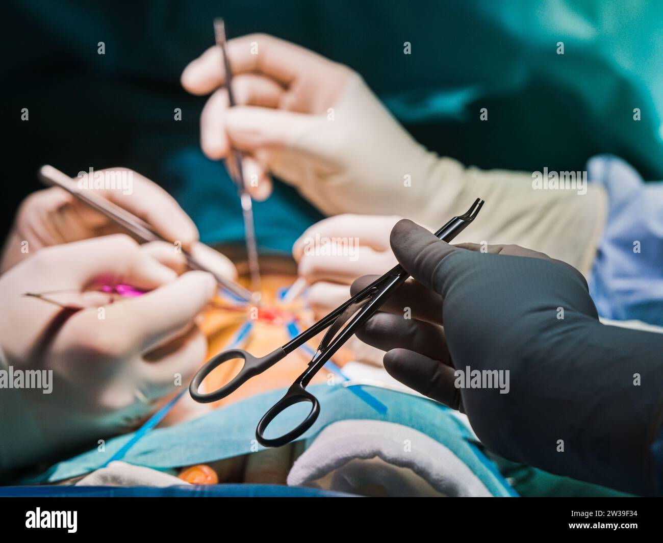 Brno, Czech Republic. 21st Dec, 2023. Lymphatic swelling surgery, a ...