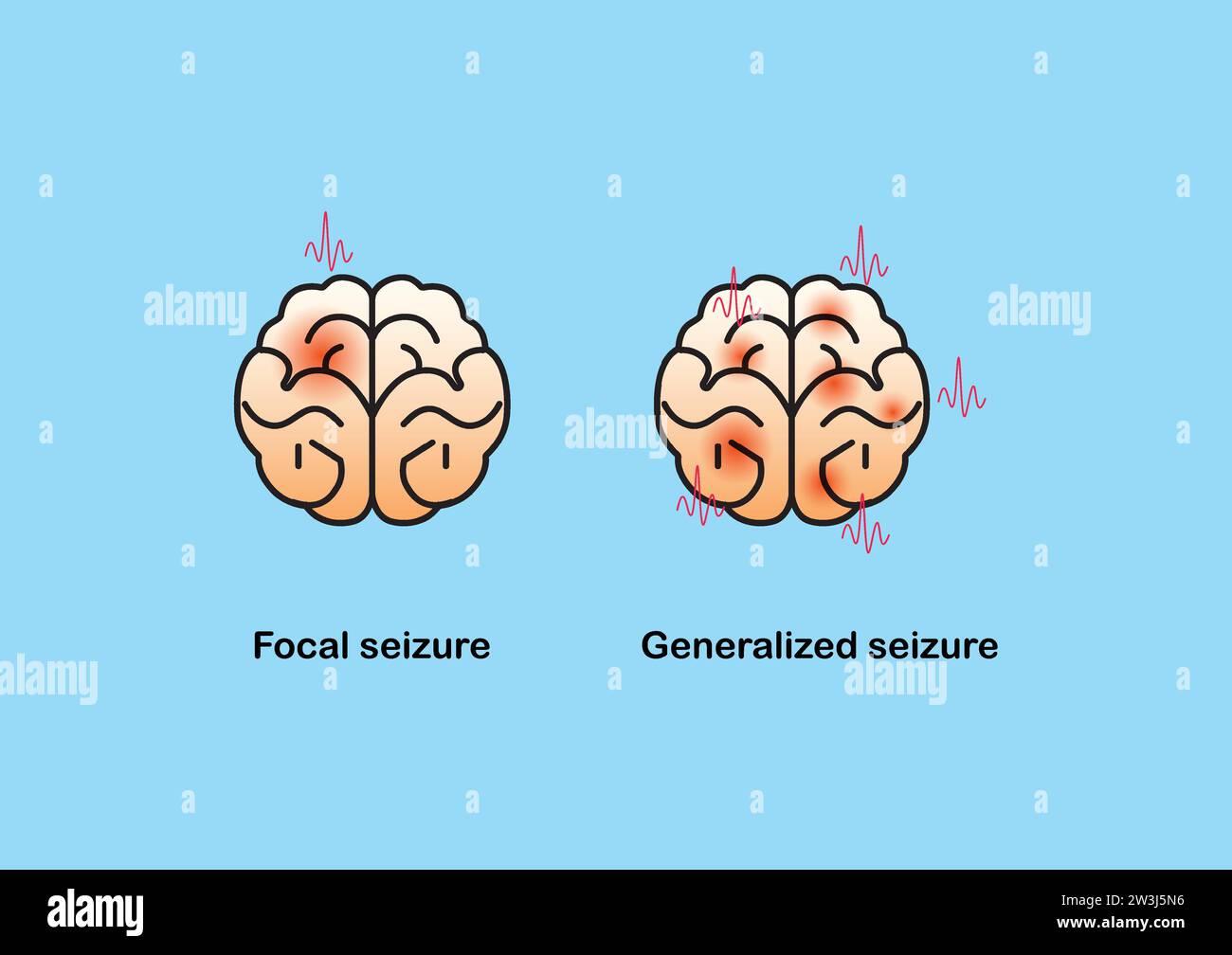 Illustration of seizure types demonstrating by onset and brain waves ...
