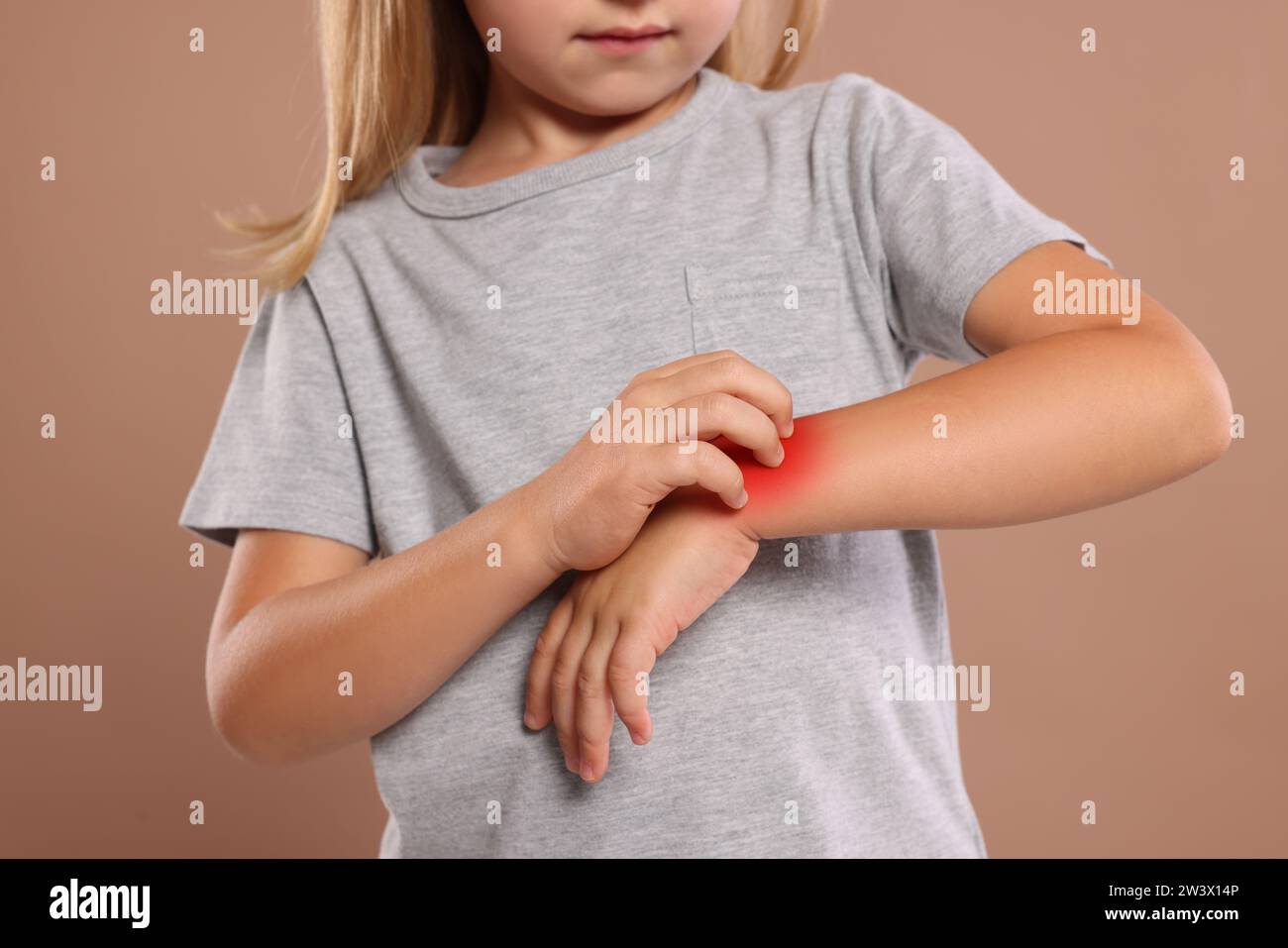 Suffering from allergy. Little girl scratching her arm on light brown ...