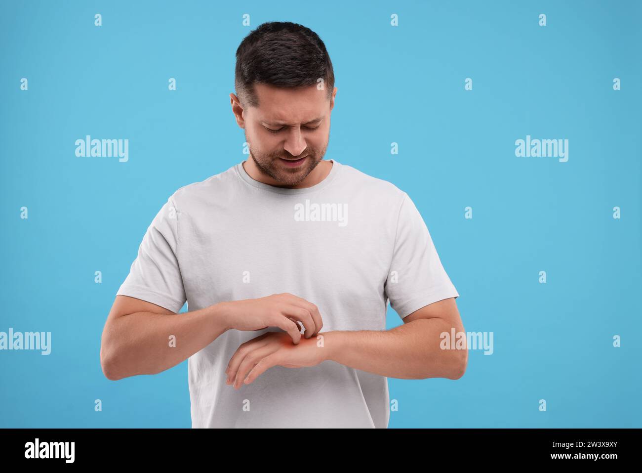 Allergy symptom. Man scratching his hand on light blue background Stock ...