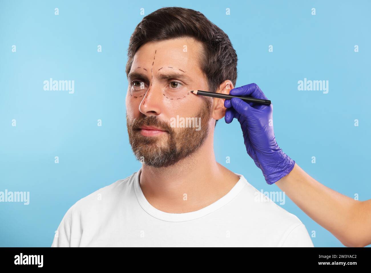 Doctor drawing marks on man's face for cosmetic surgery operation ...