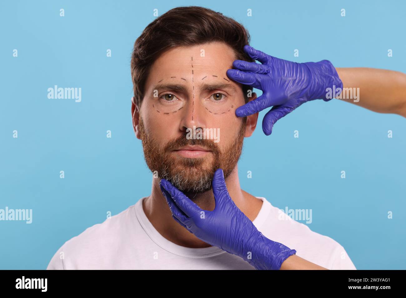 Doctor checking marks on man's face for cosmetic surgery operation ...