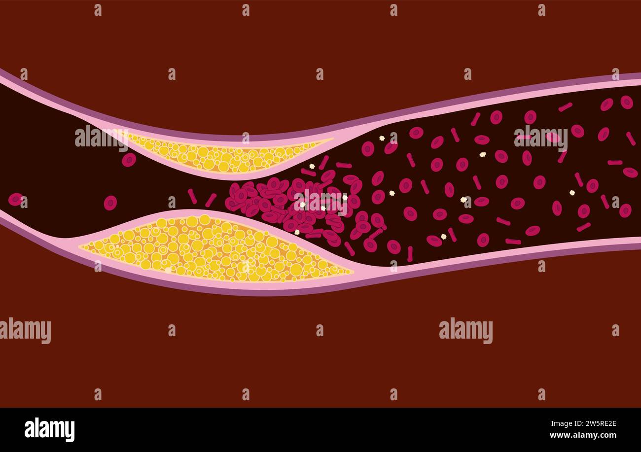 Plaque artery cross section Stock Vector Images - Alamy