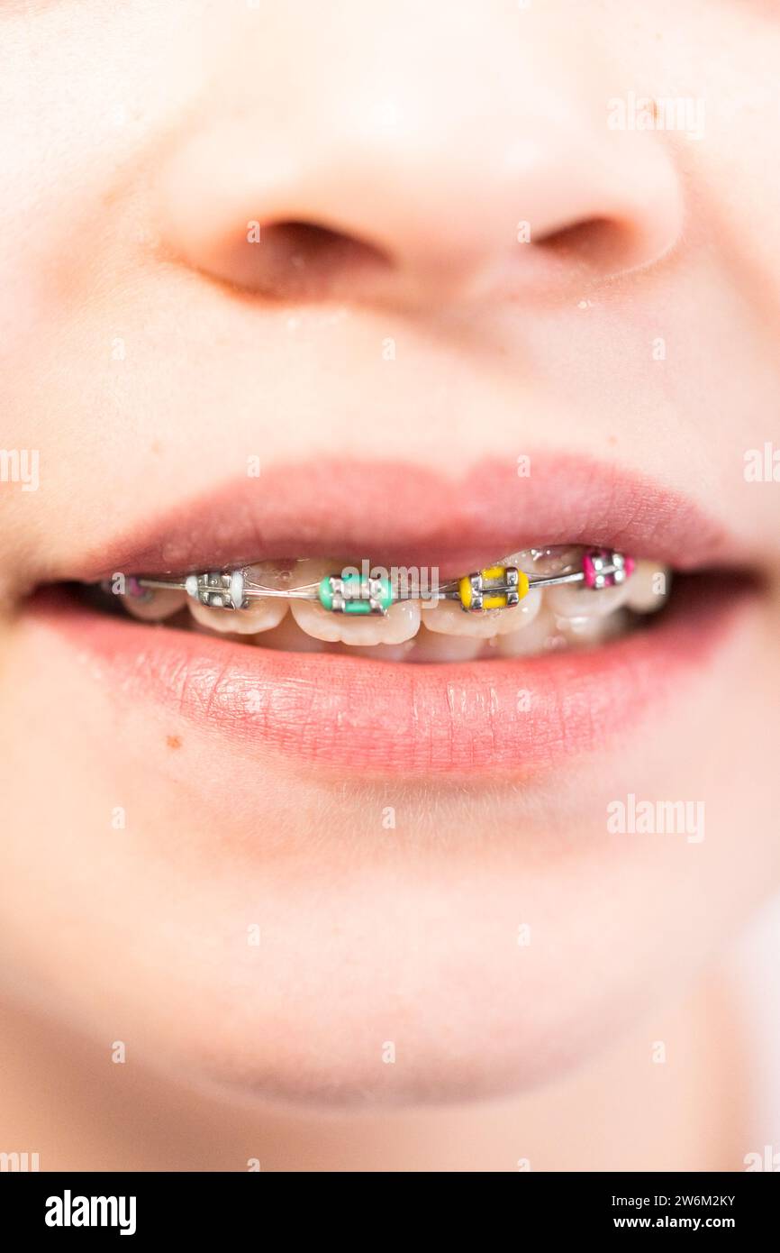 Little girl with rainbow braces Stock Photo - Alamy