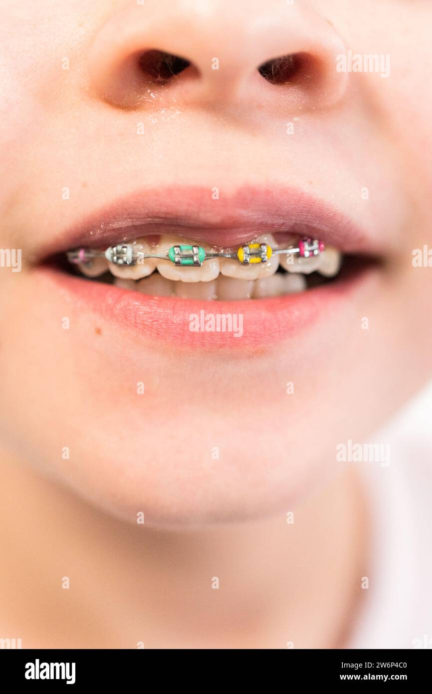 Little girl with rainbow braces Stock Photo - Alamy
