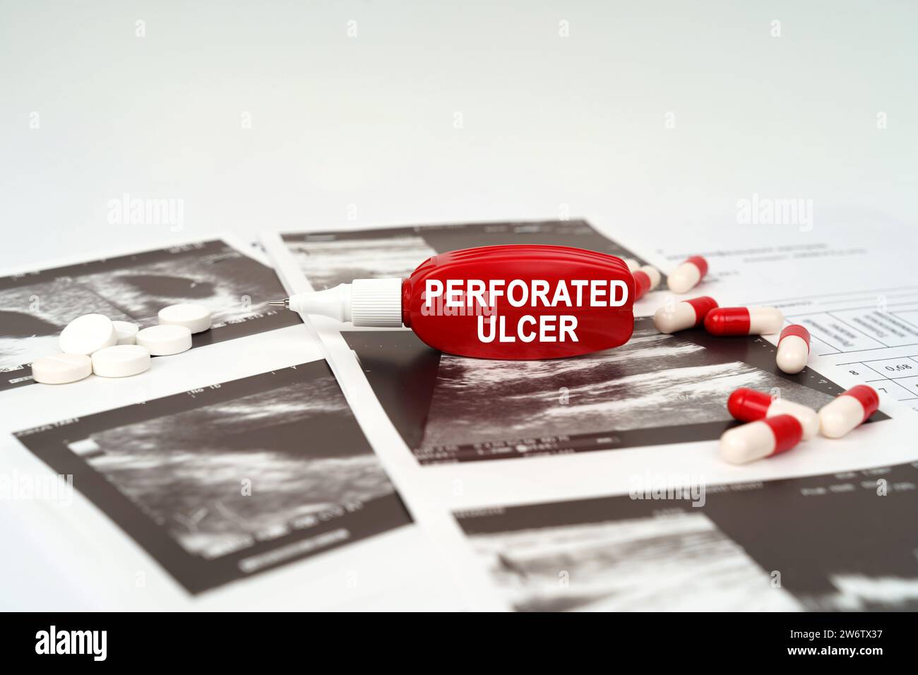 Medical concept. On the ultrasound pictures there are pills and a pen ...