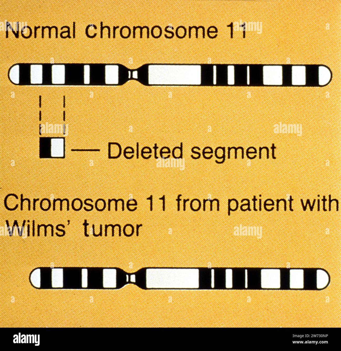 Wilms tumor hi-res stock photography and images - Alamy