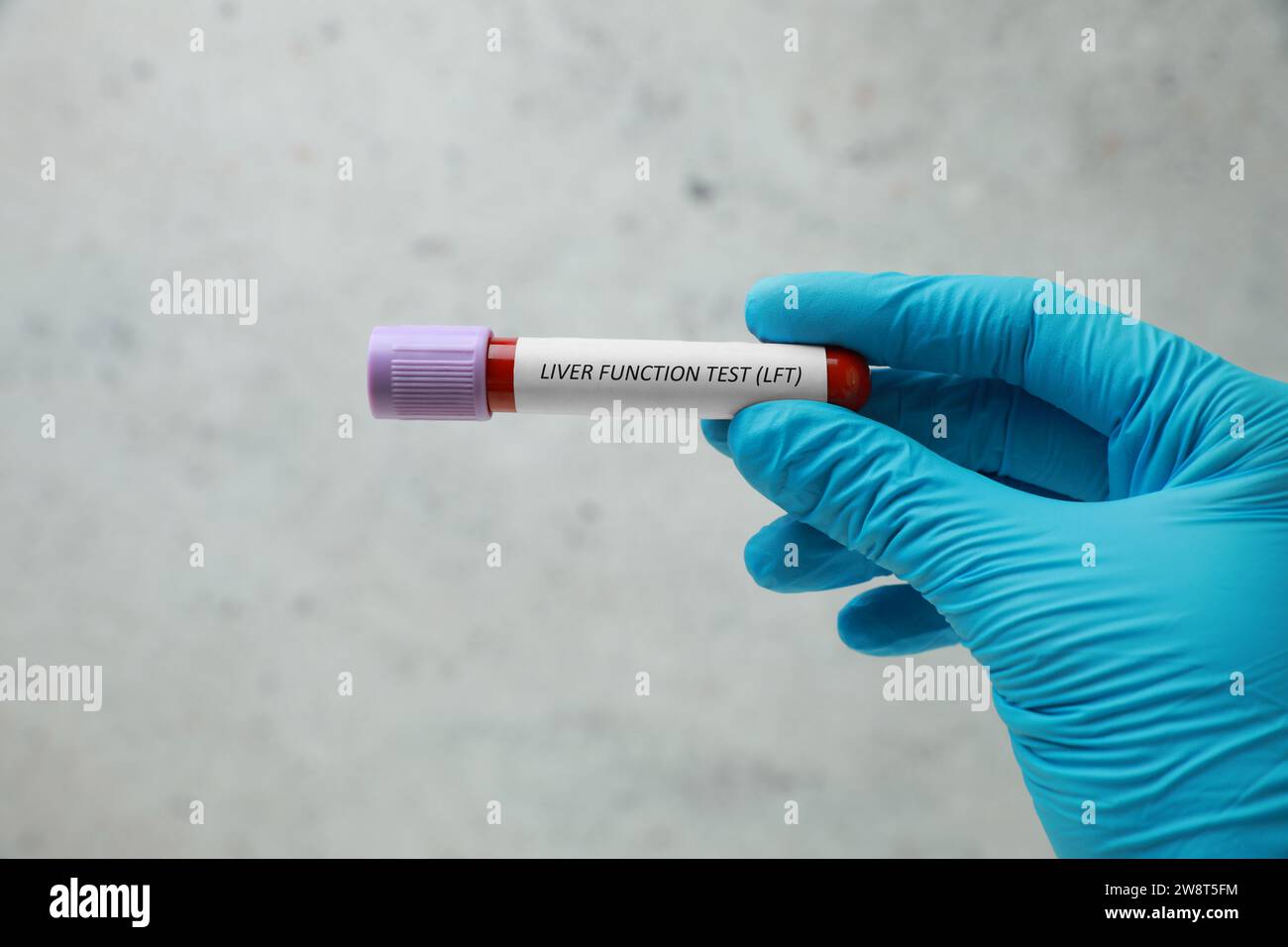 Laboratory worker holding tube with blood sample and label Liver ...