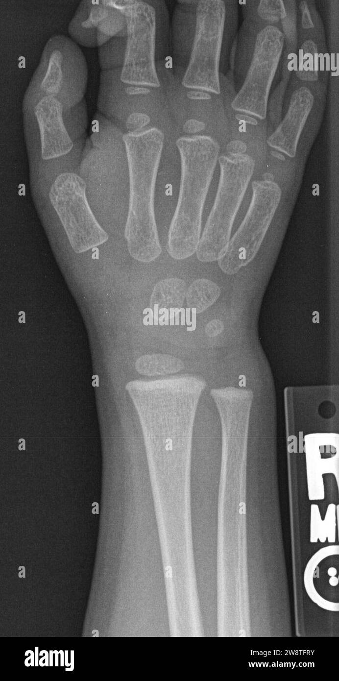 X-ray of the wrist of a 2 year old male - posteroanterior 2 Stock Photo ...