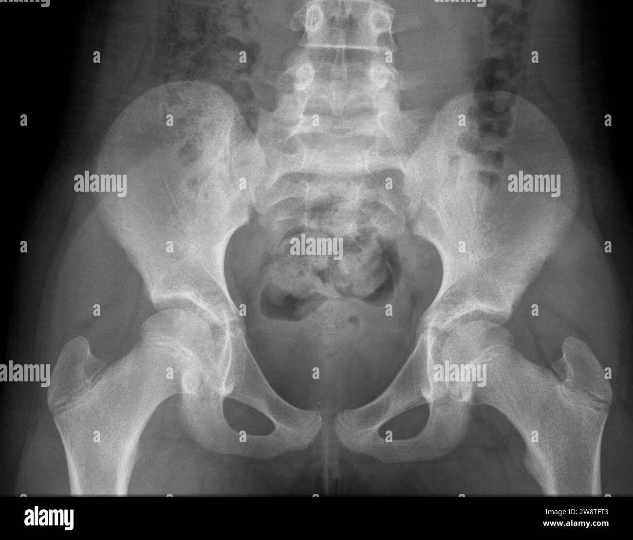 X-ray of the pelvis of a 10 year old female - case 1 - anteroposterior ...