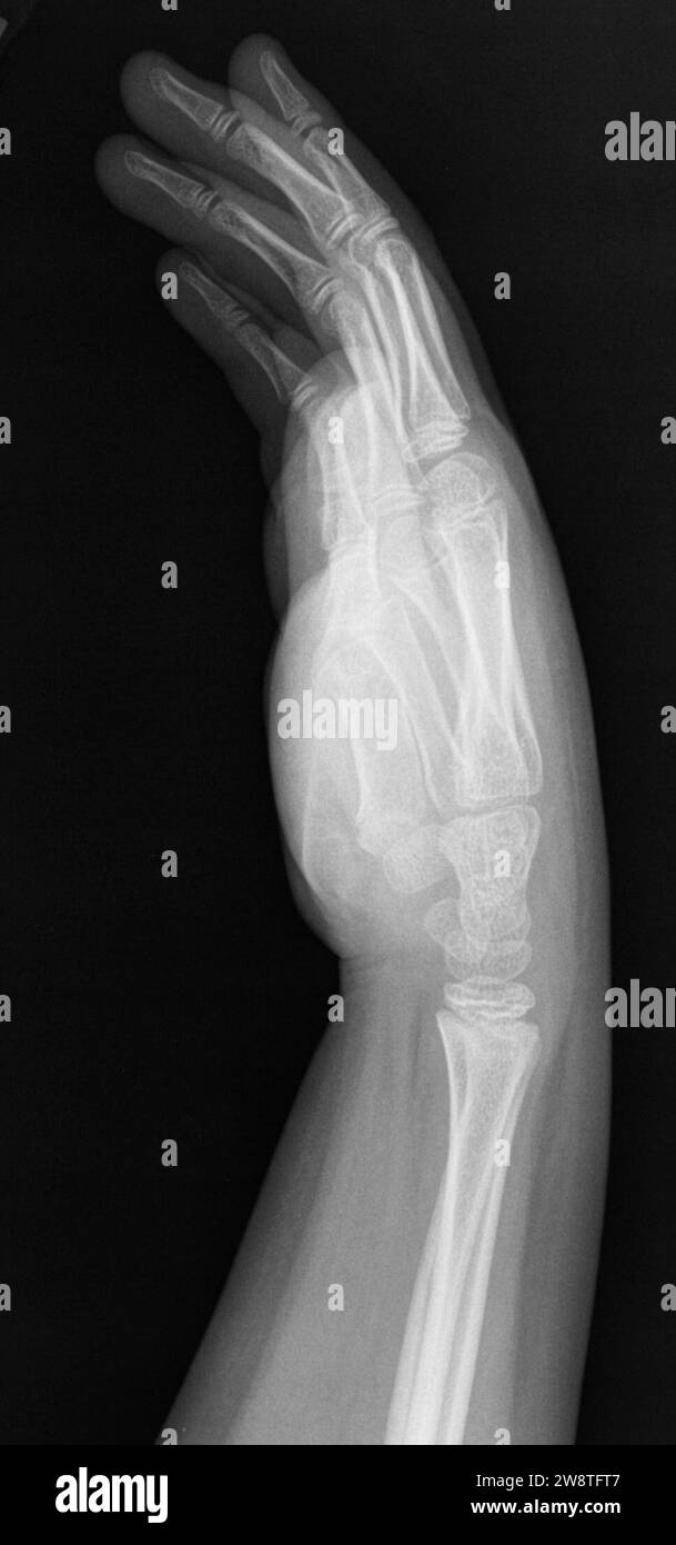 X-ray of the hand of an 8 year old male - lateral Stock Photo - Alamy