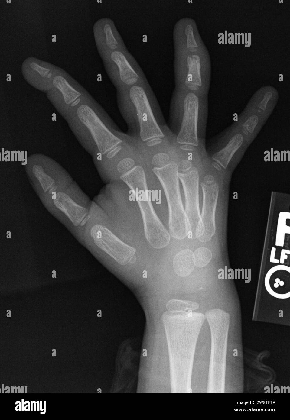 X-ray of the hand of a 4 year old male - oblique Stock Photo - Alamy