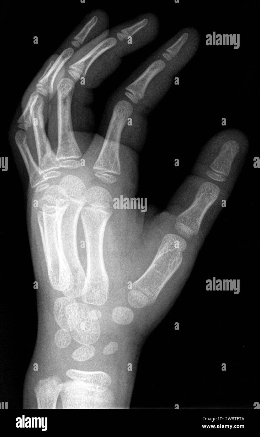 X-ray of the hand of a 5 year old male - case 2 - lateral Stock Photo ...