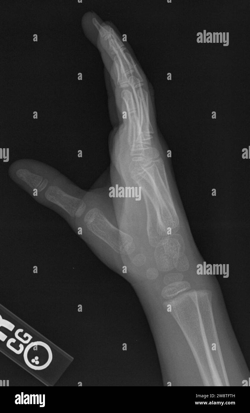 X-ray of the hand of a 7 year old male - lateral Stock Photo - Alamy