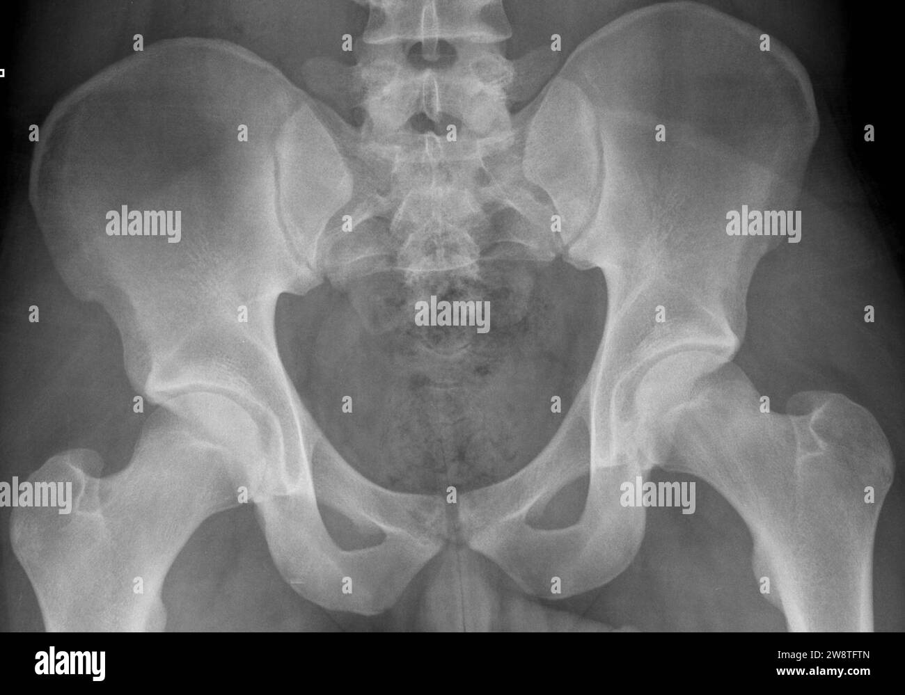 X Ray Of The Pelvis Of An 18 Year Old Male Case 3 Anteroposterior