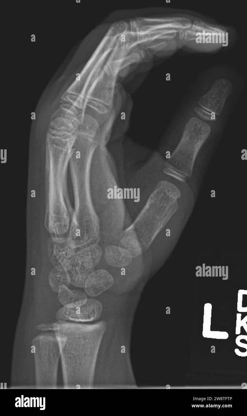 X-ray of the hand of a 6 year old male - lateral Stock Photo - Alamy
