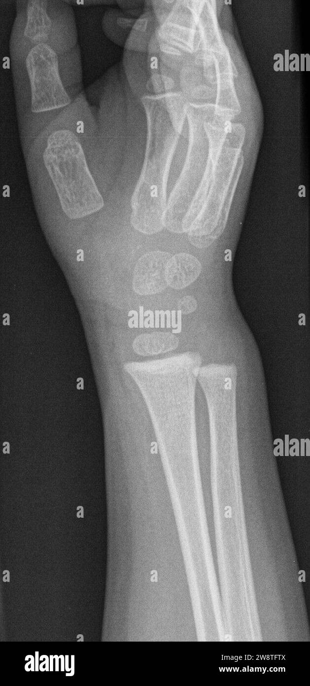X-ray of the wrist of a 2 year old male - oblique Stock Photo - Alamy
