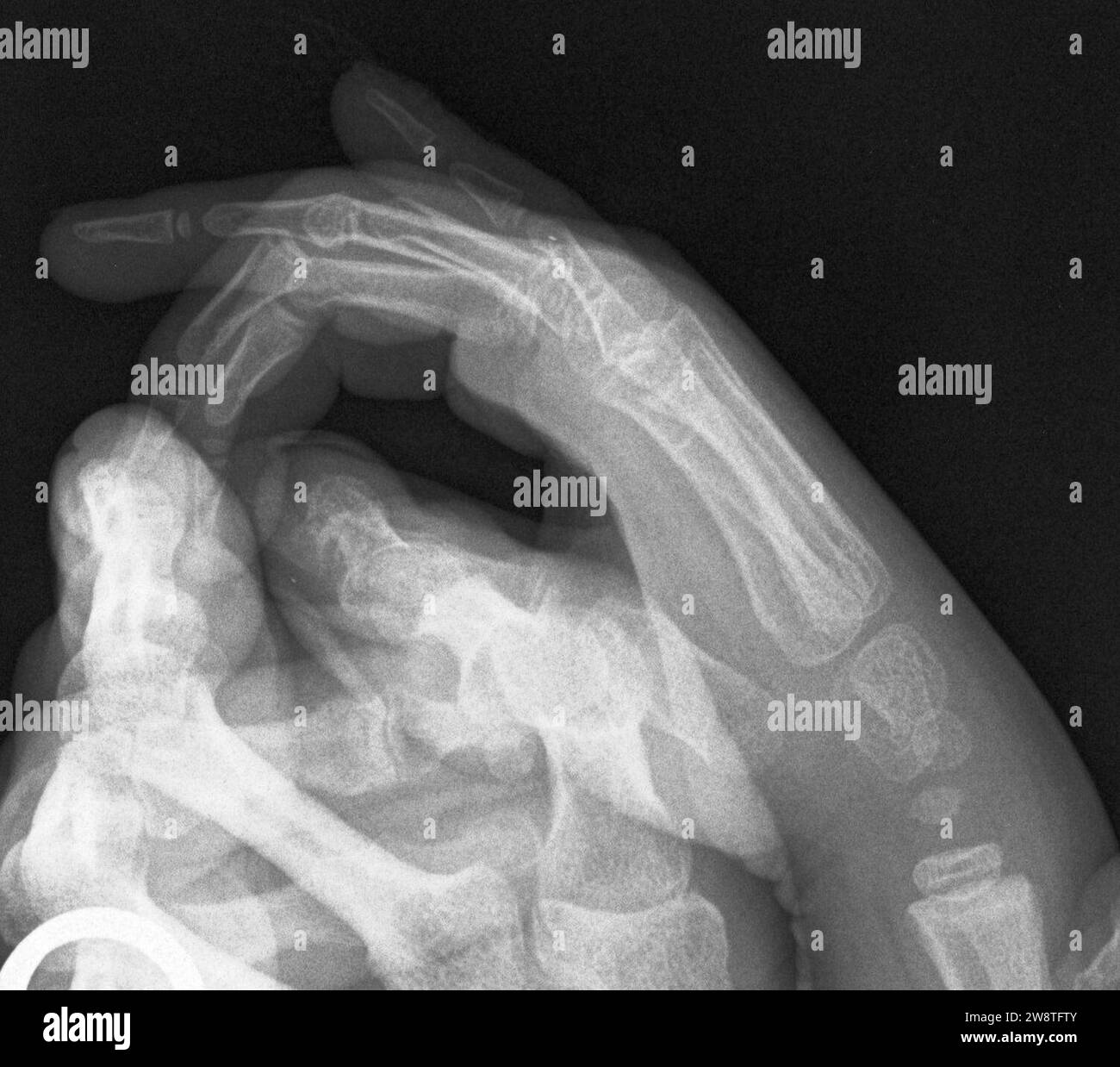 X-ray of the hand of a 5 year old male - lateral Stock Photo - Alamy