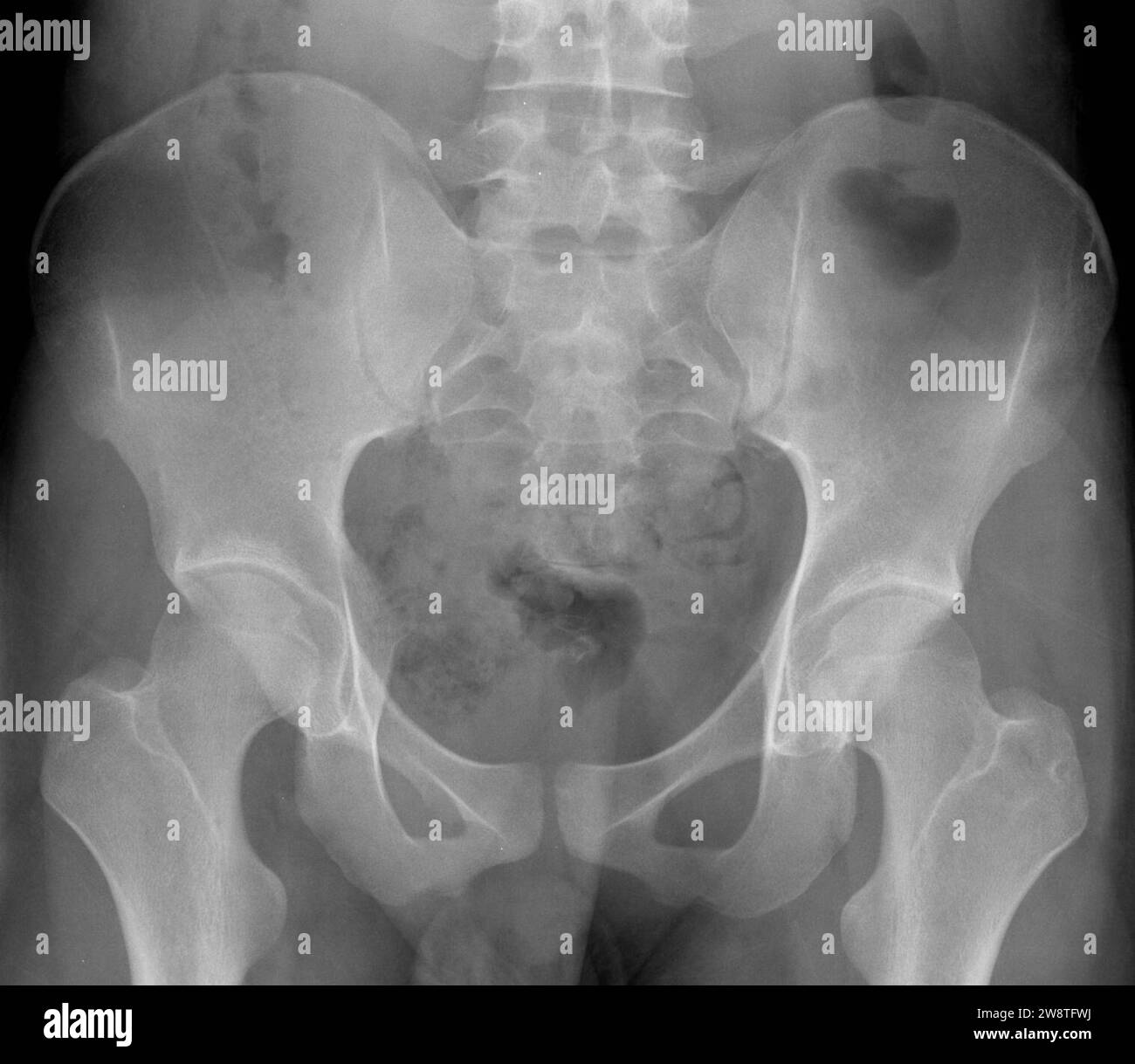 X-ray of the pelvis of an 18 year old male - case 2 - anteroposterior ...