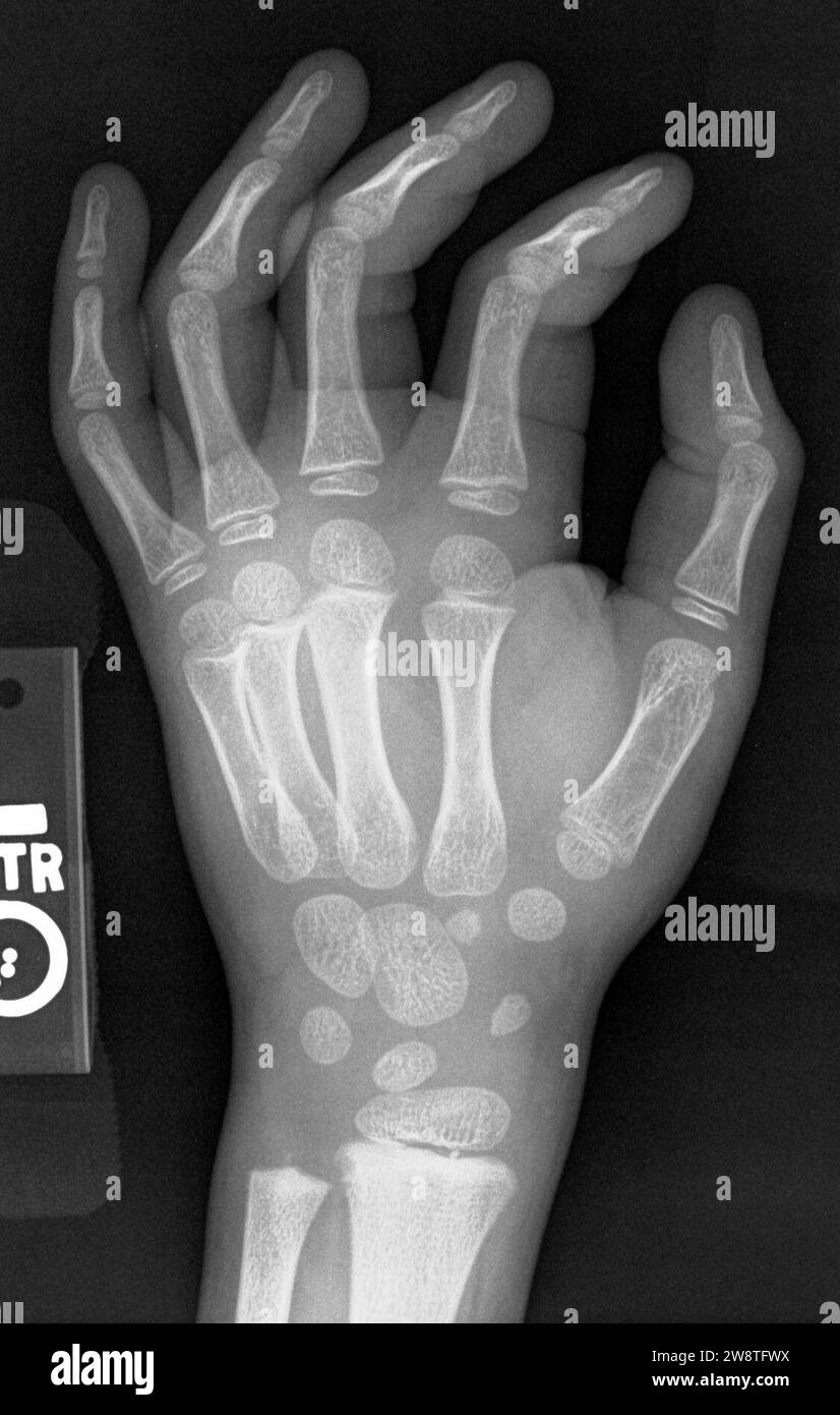 X-ray of the hand of a 5 year old male - case 2 - oblique Stock Photo ...