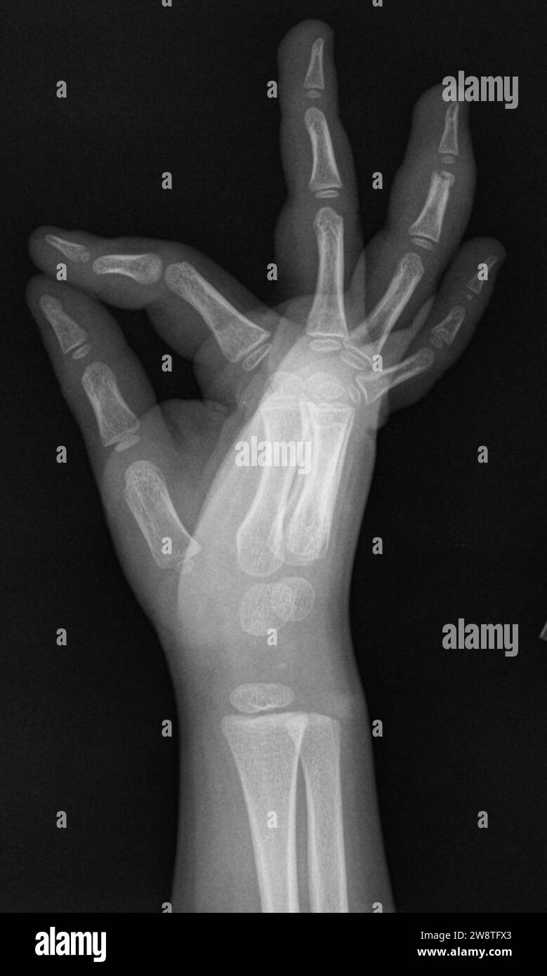 X-ray of the hand of a 4 year old male - lateral Stock Photo - Alamy
