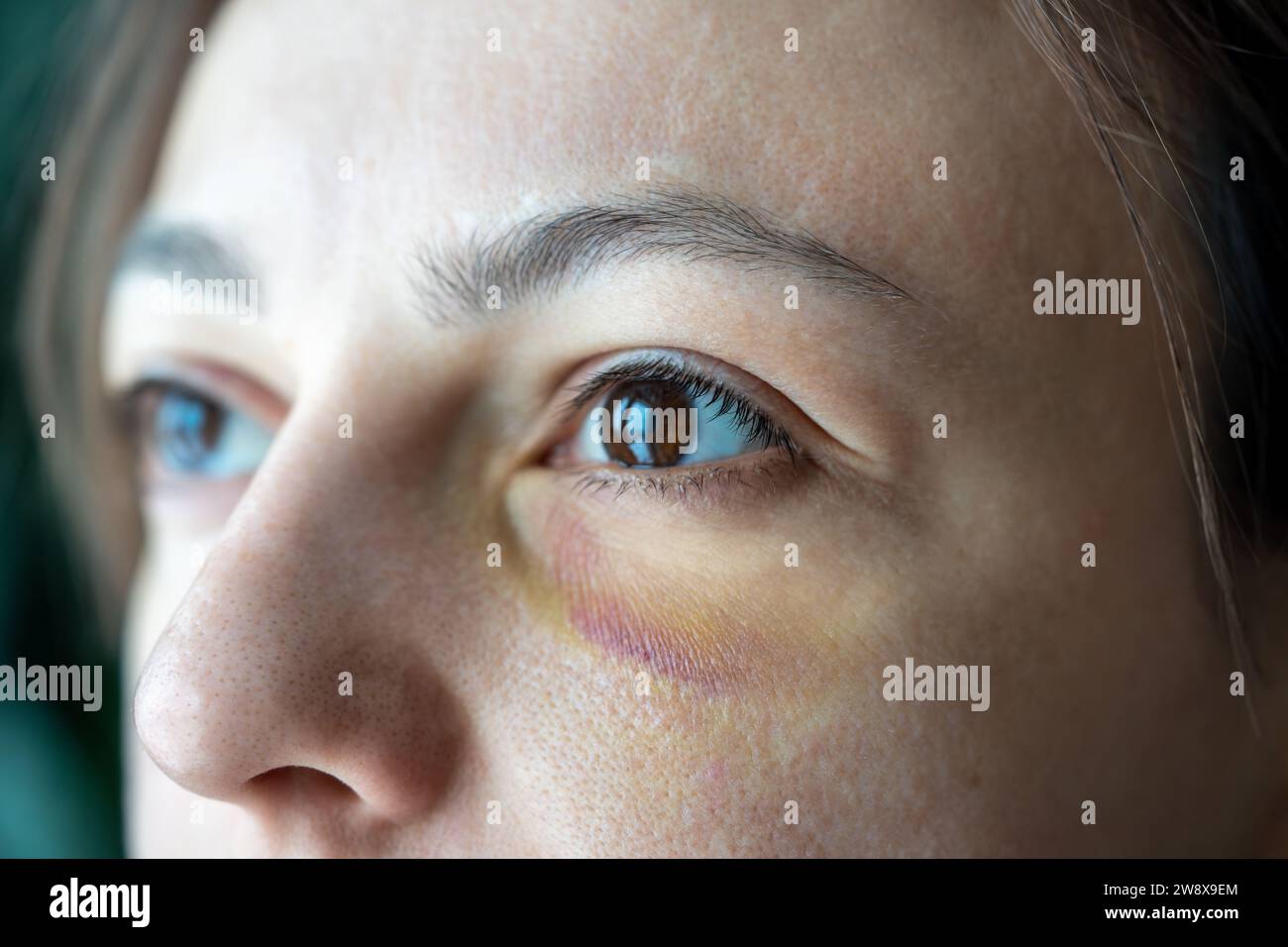 Victim of home violence with black eye on face. Hematoma, trauma caused ...