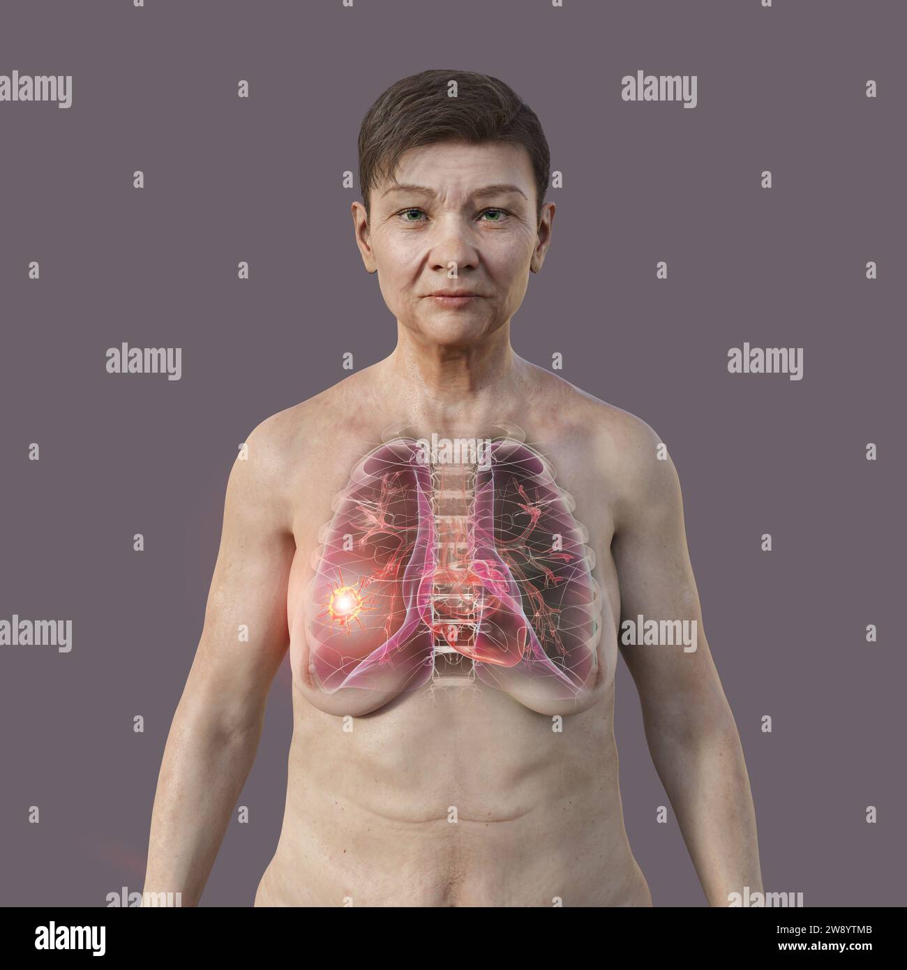 Lung cancer pulmonary organs hi-res stock photography and images - Alamy