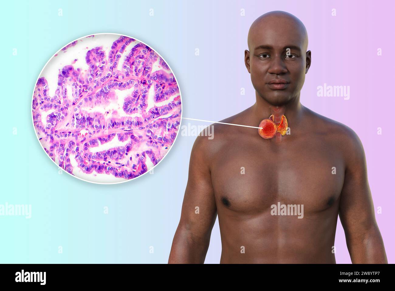 Thyroid cancer, illustration Stock Photo - Alamy