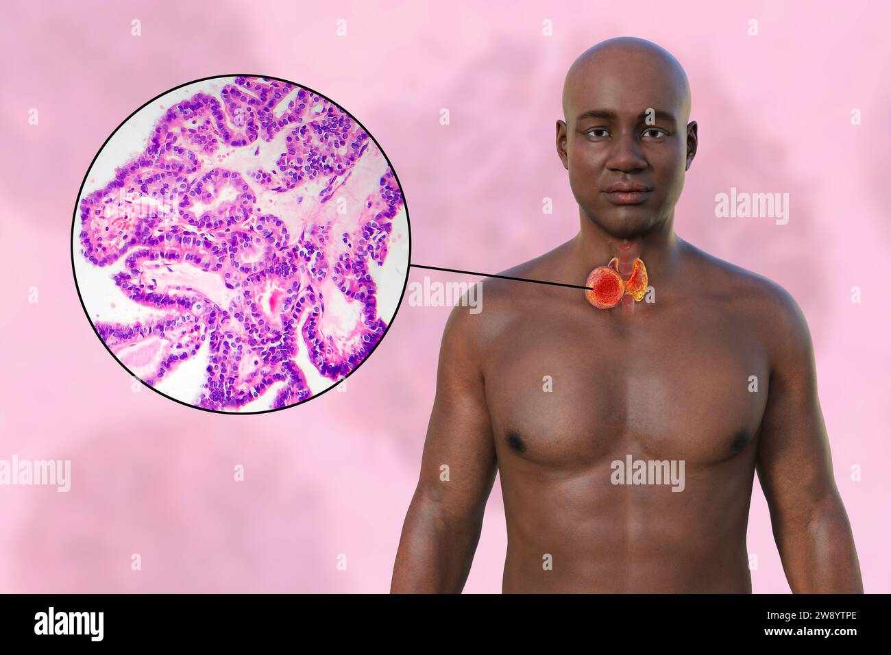 Thyroid cancer, illustration Stock Photo - Alamy