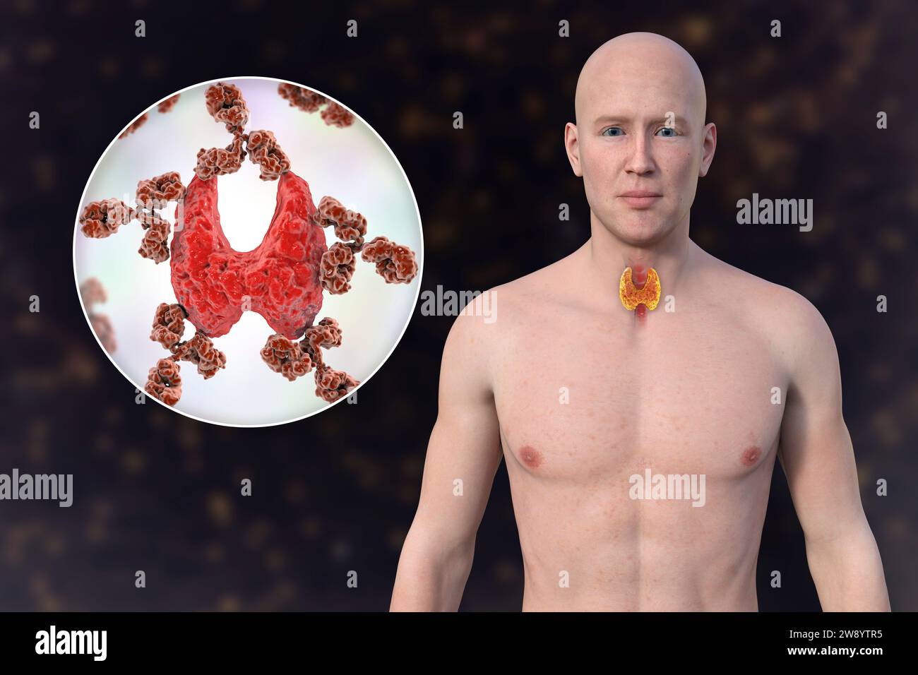 Antibodies Hashimoto's Disease at Lee Porter blog