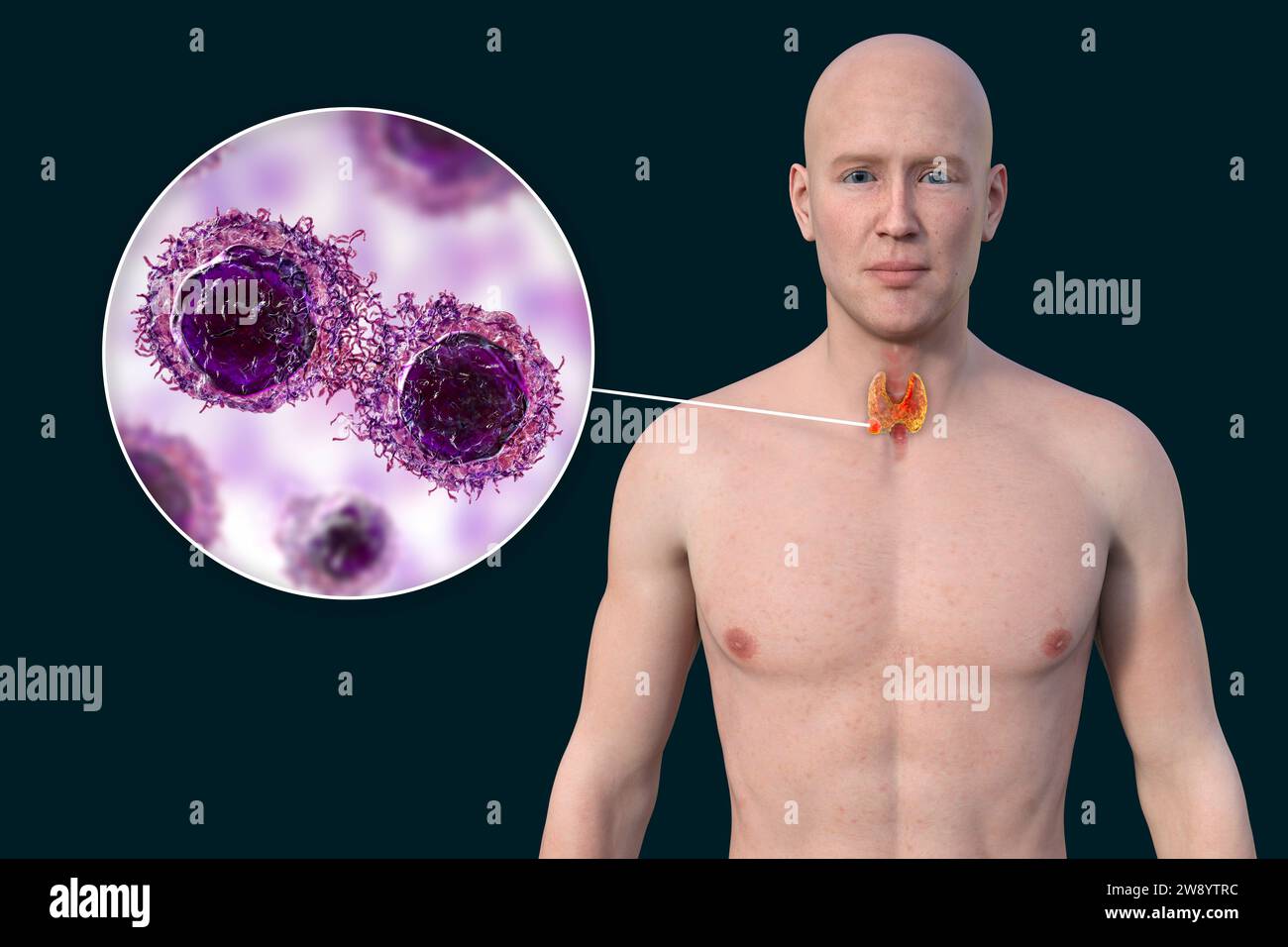Thyroid cancer, illustration Stock Photo - Alamy