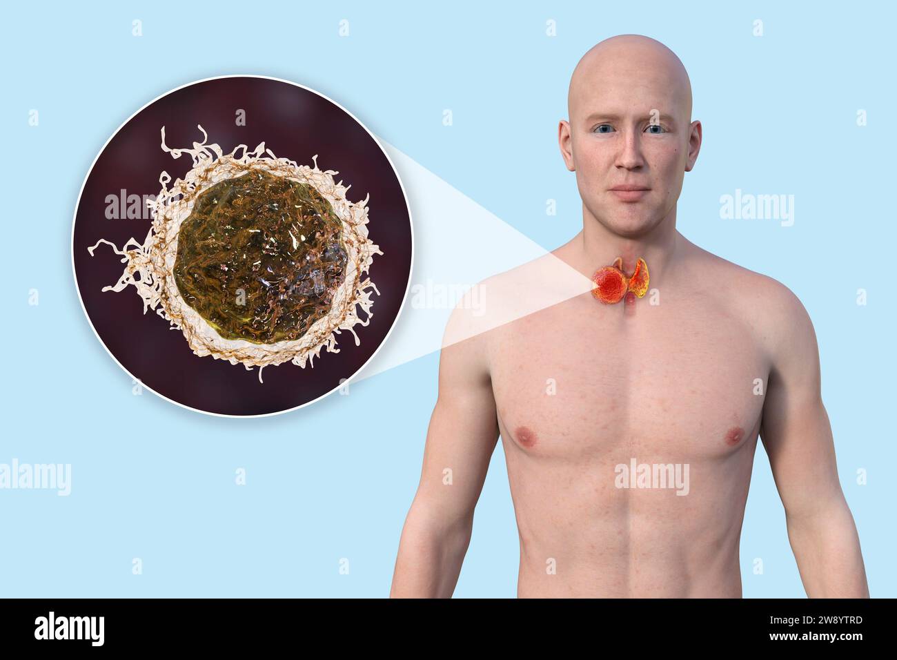 Nodular thyroid disease hi-res stock photography and images - Alamy