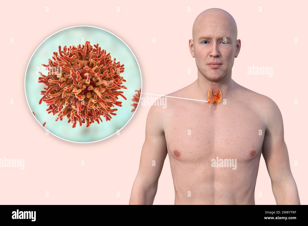 Thyroid cancer cell hi-res stock photography and images - Alamy