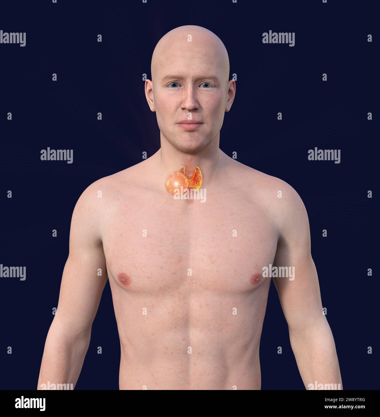 Thyroid cancer, illustration Stock Photo - Alamy