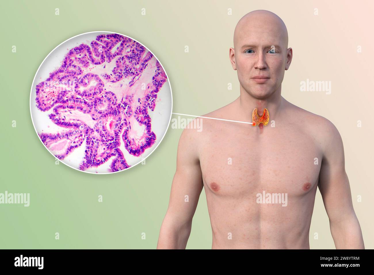 Thyroid cancer, illustration Stock Photo - Alamy