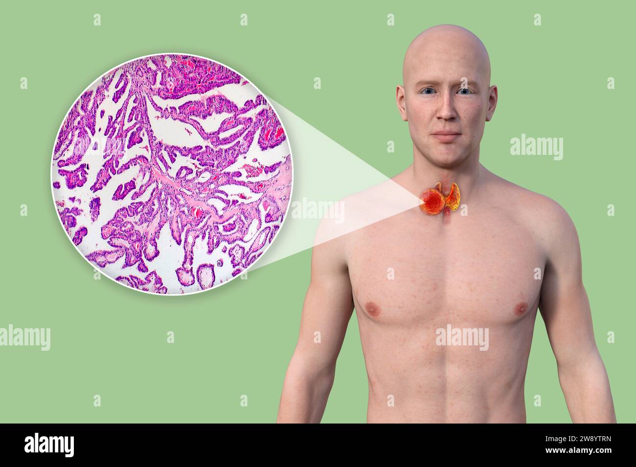 Thyroid cancer cell hi-res stock photography and images - Alamy