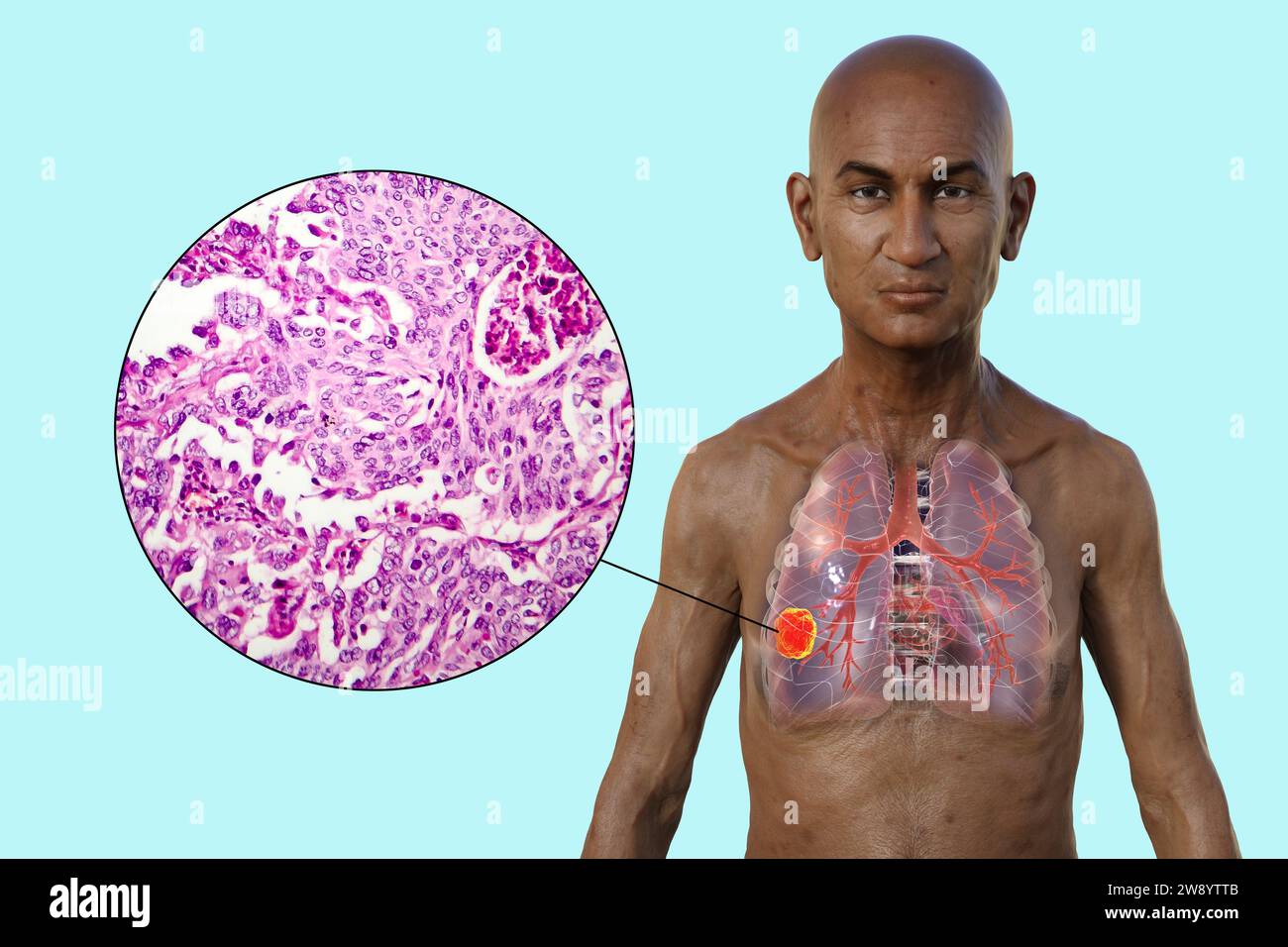 Lung cancer and light micrograph hi-res stock photography and images ...