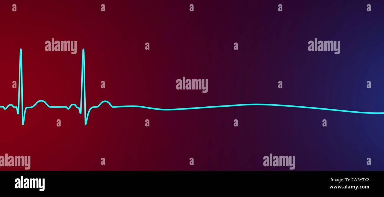 Asystole cardiac arrest, illustration Stock Photo - Alamy
