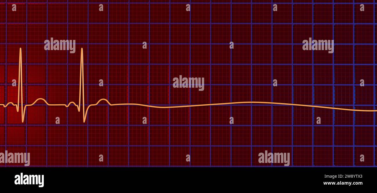 Cardiac arrest hi-res stock photography and images - Alamy