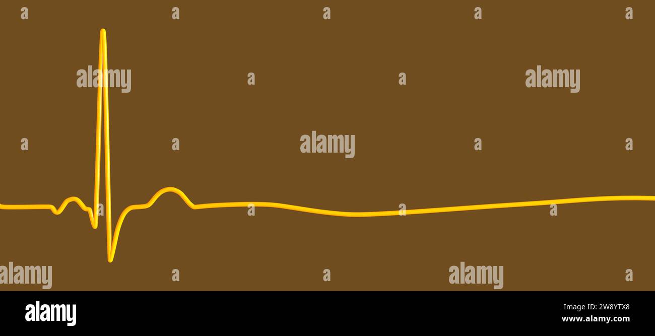 Asystole cardiac arrest, illustration Stock Photo - Alamy
