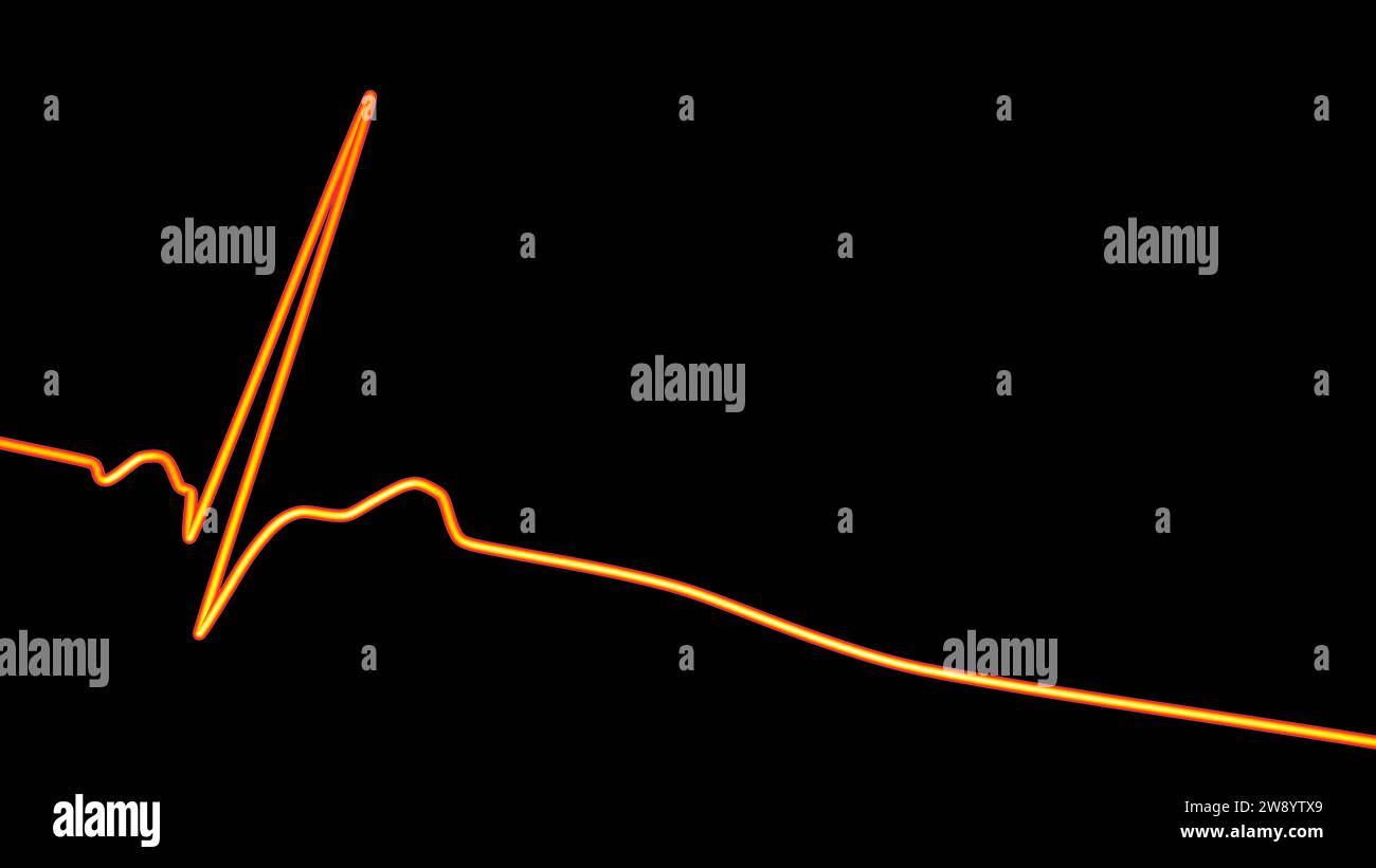 Asystole cardiac arrest, illustration Stock Photo - Alamy