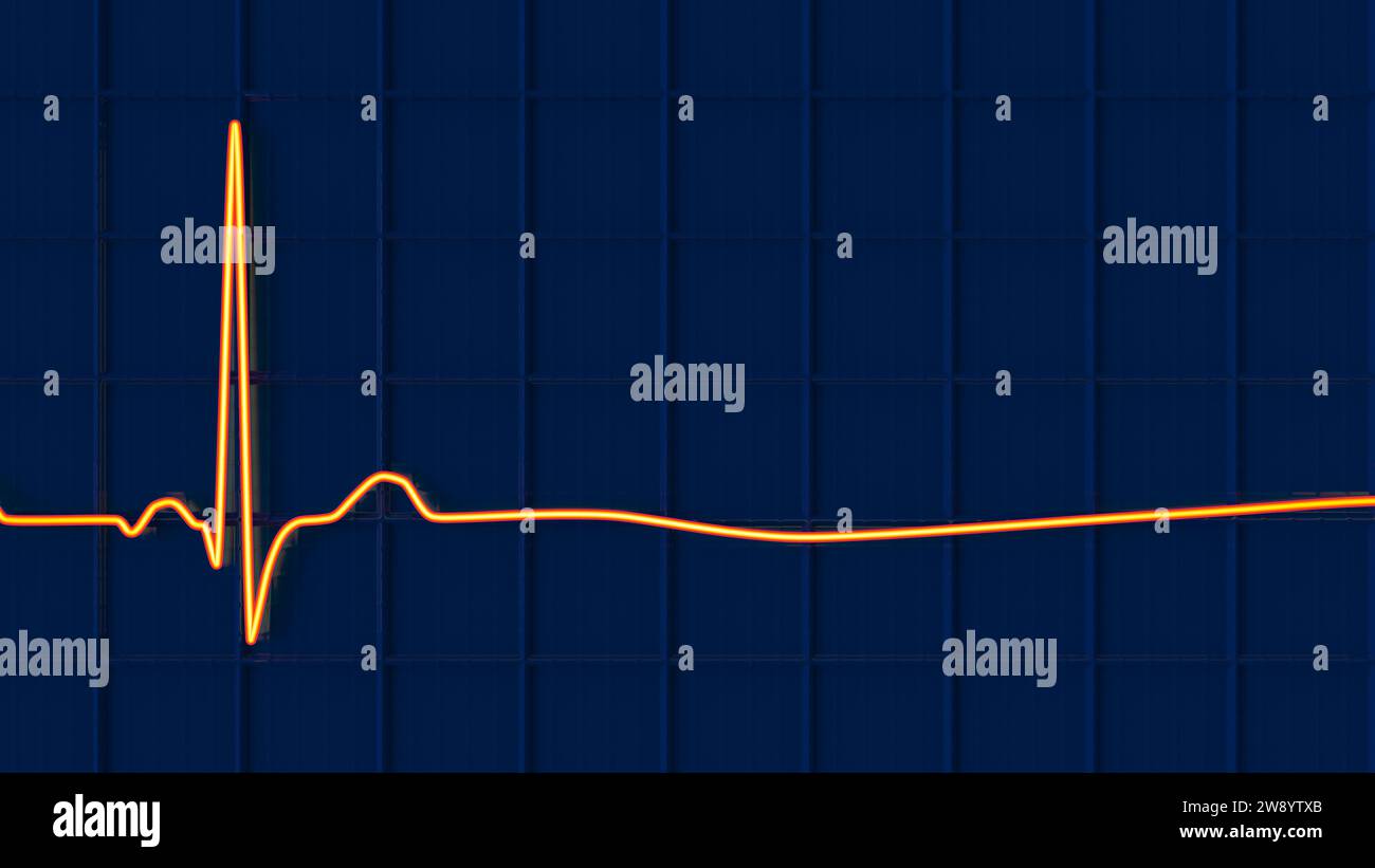 Illustration showing a flatline on an electrocardiogram (ECG ...