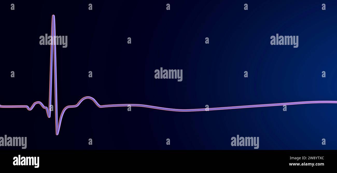Asystole cardiac arrest, illustration Stock Photo - Alamy